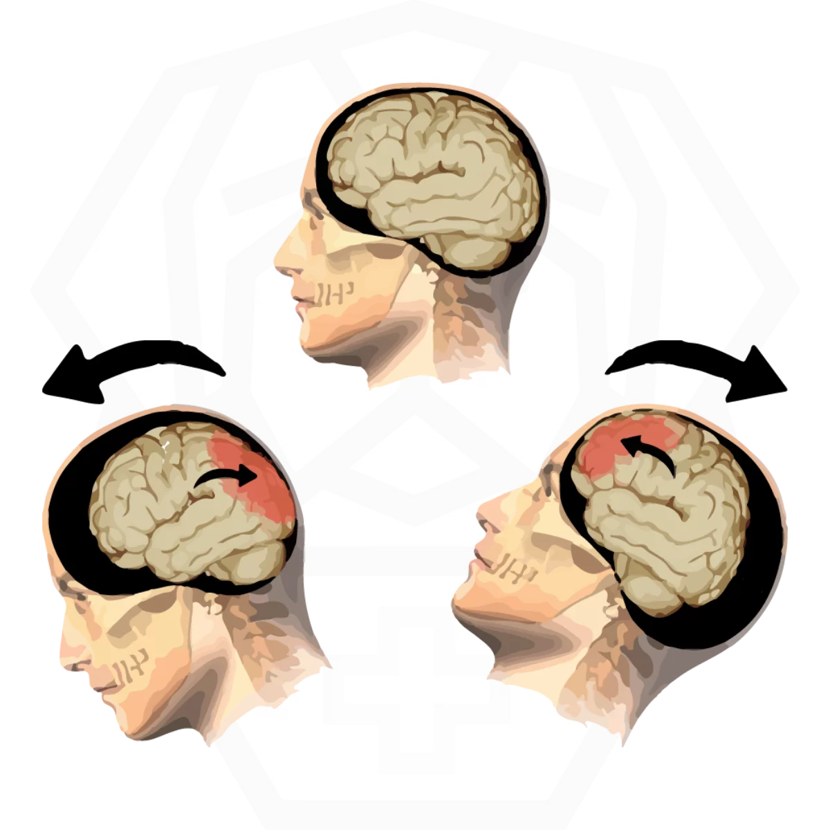 Formation :Premiers secours – Commotion cérébrale (1.5h)